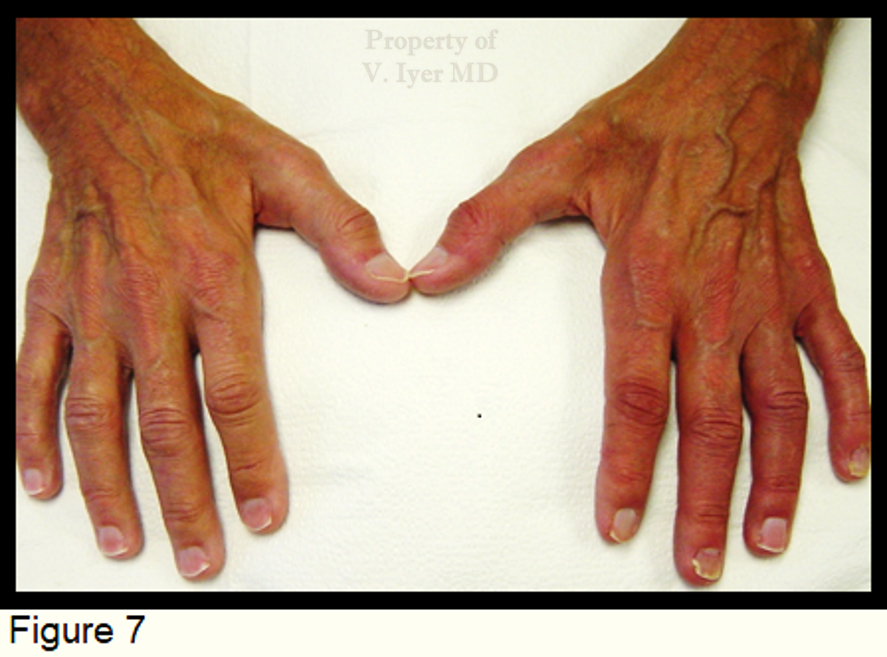 Amyotrophic Lateral Sclerosis (ALS, Lou Gehrig’s disease ...